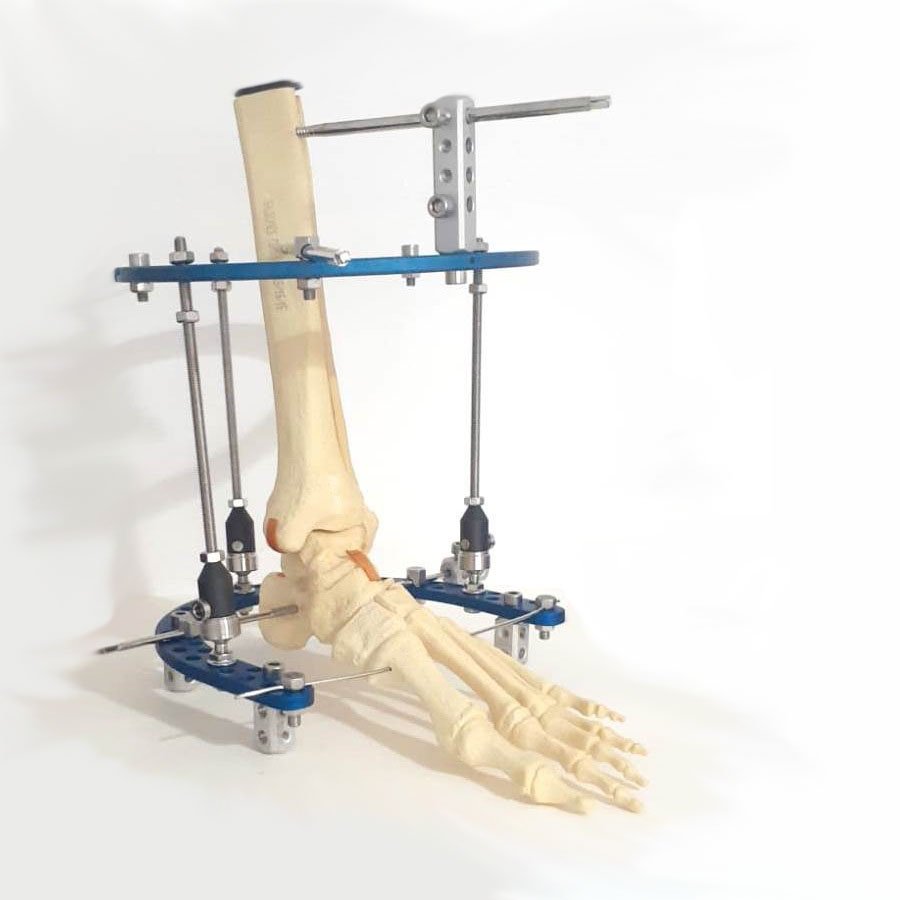 Eksternal Fiksatör - Klinik Bilgiler - 1