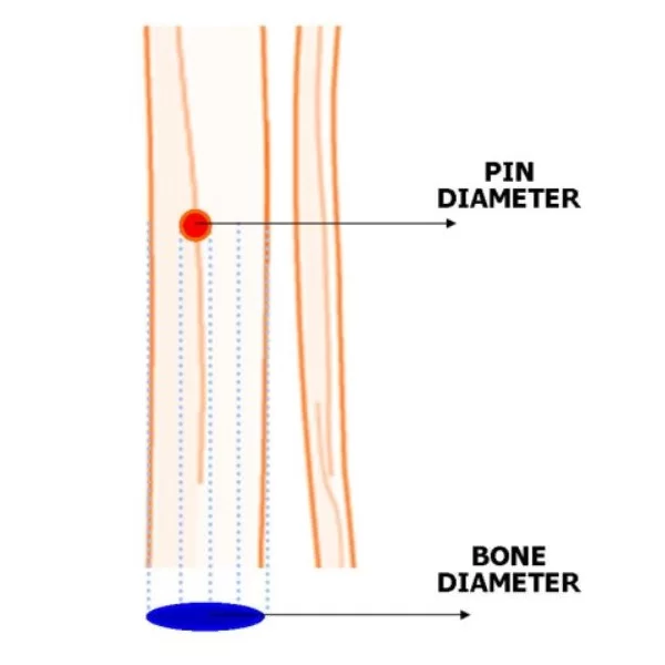 External Fixator Pin Placement Principals