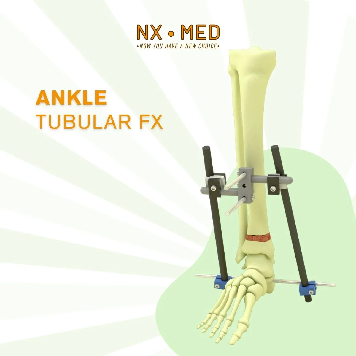 External Fixator System Monolateral Dynamic Fixator