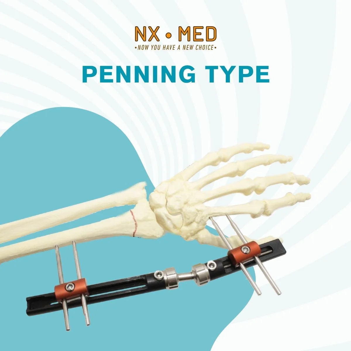 PENEF - Pennig Type Wrist Fixator - Monolateral Dynamic Wrist Fixator