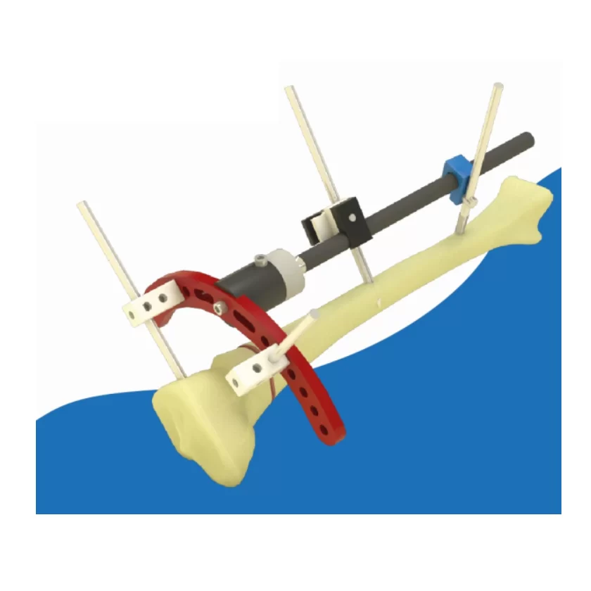Eksternal Fiksasyon Sistemi Büyük Hibrid Fiksatör