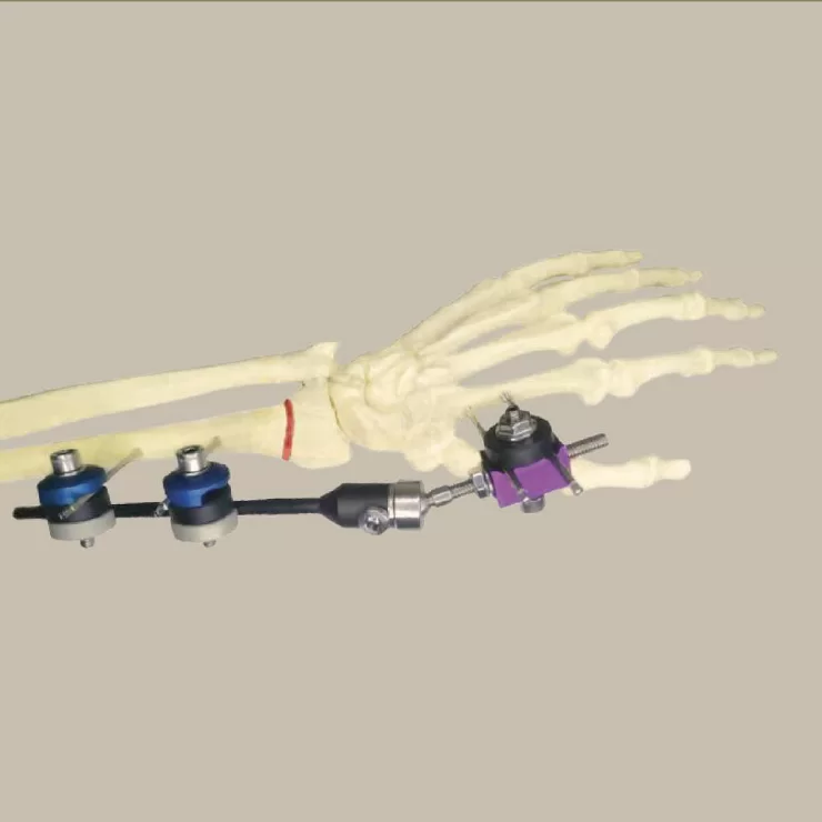 Small Fixators - Wrist, Forearm and Pediatric Fixator Systems